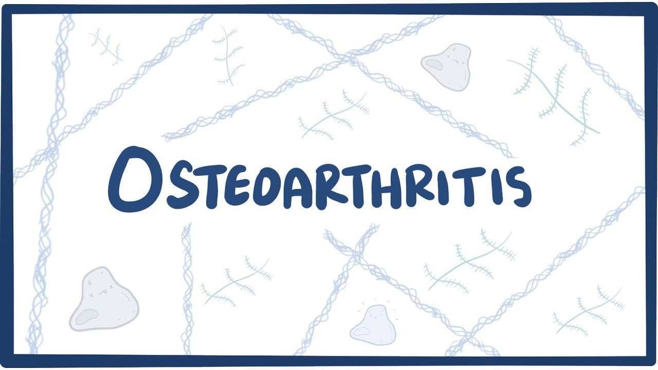Osteoarthritis Causes Symptoms Diagnosis Treatment Pathology